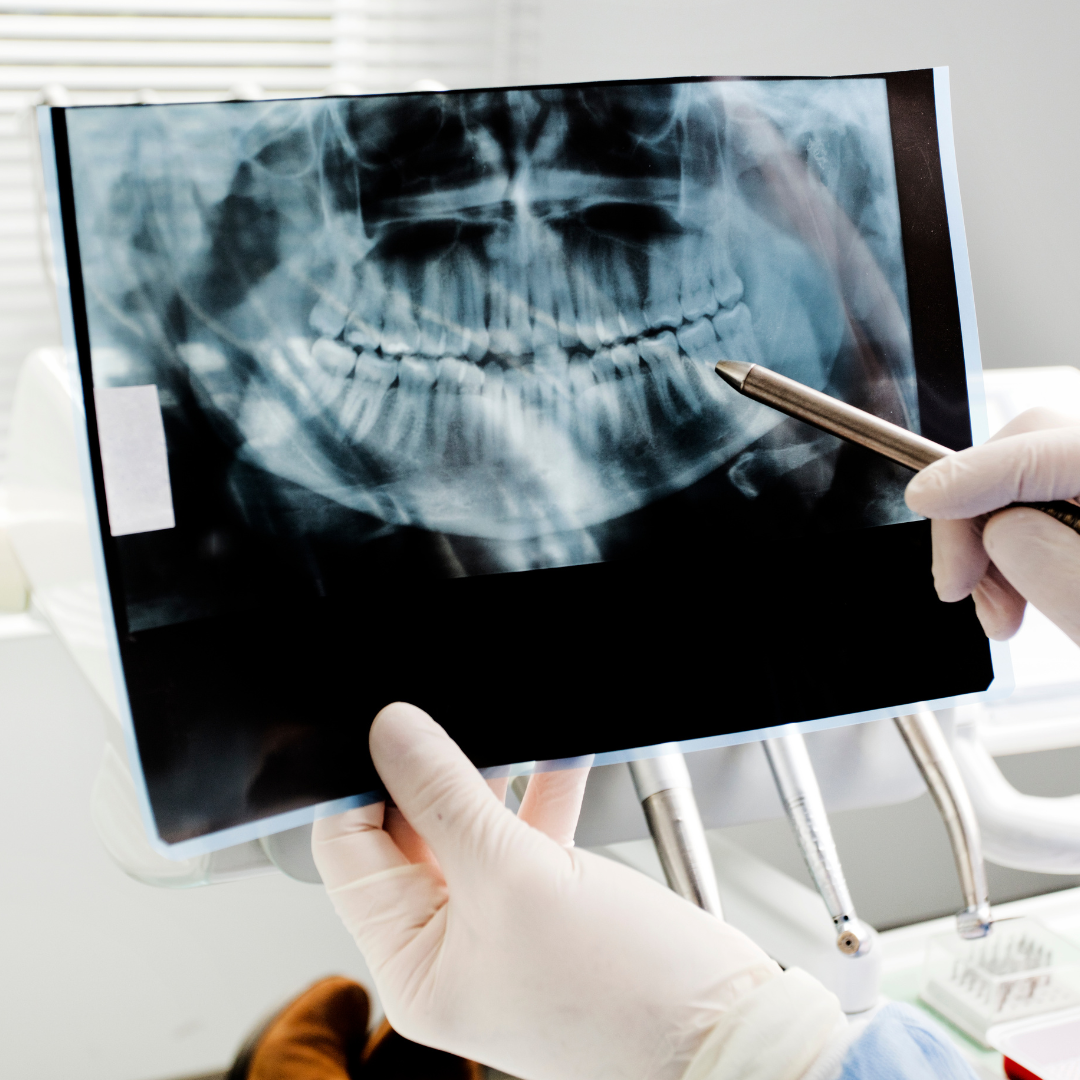Dental X-rays: Safety, Benefits, and Why They're Important